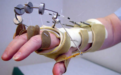 Uncommon Nerve Compression Syndromes | Elbow Specialist | South Windsor ...