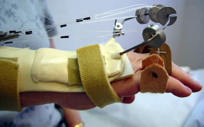 Uncommon Nerve Compression Syndromes | Elbow Specialist | South Windsor ...