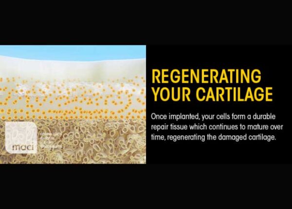 MACI | Matrix-Induced Autologous Chondrocyte Implantation | Biologic ...